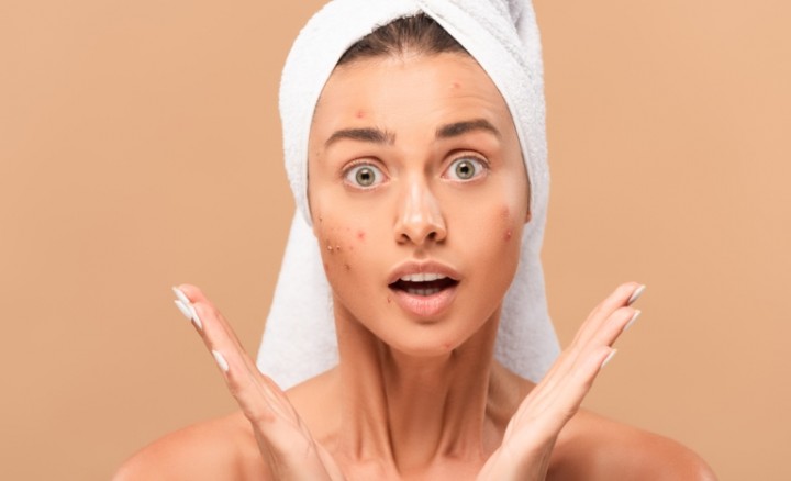 Mapa tváre alebo čo ukazuje akné