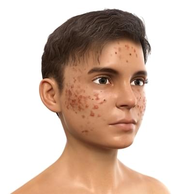 Mapa tváre alebo čo ukazuje akné